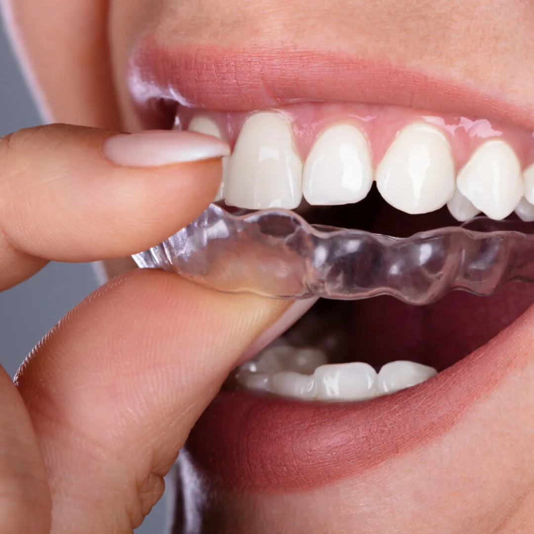 Oral Joint Disorders - candidsmiles.in